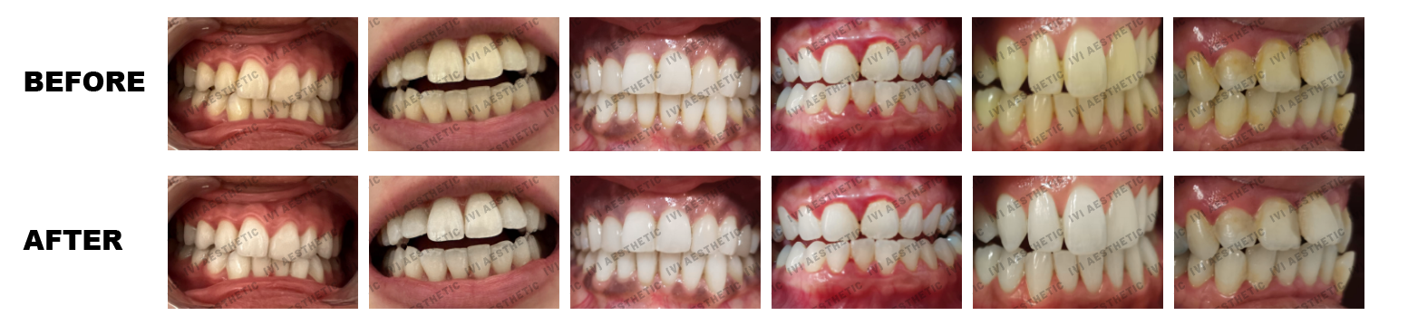 LED Teeth Whitening Treatment - IVI Aesthetic